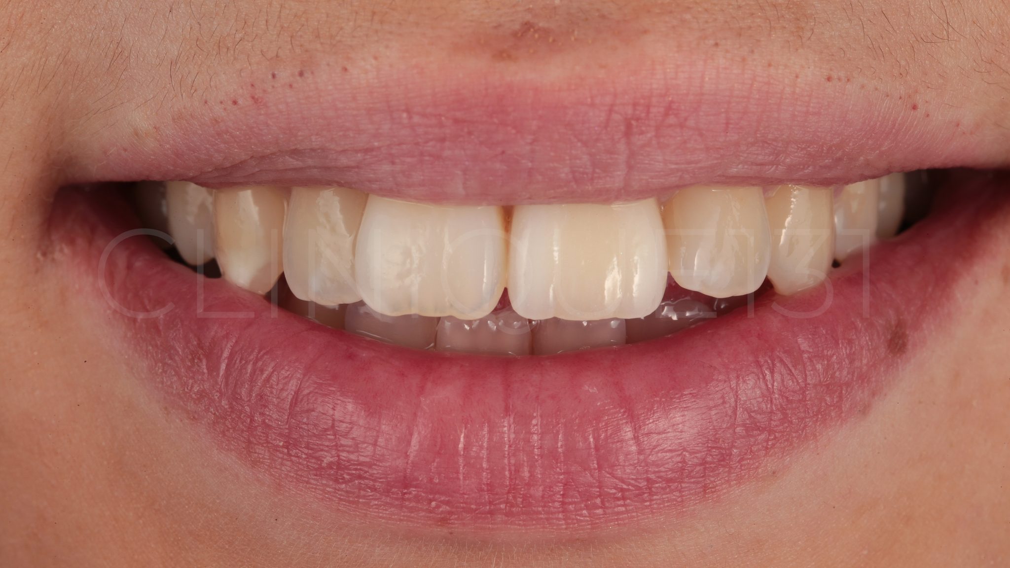 Je souhaite remplacer mes dents de devant Clinique 131