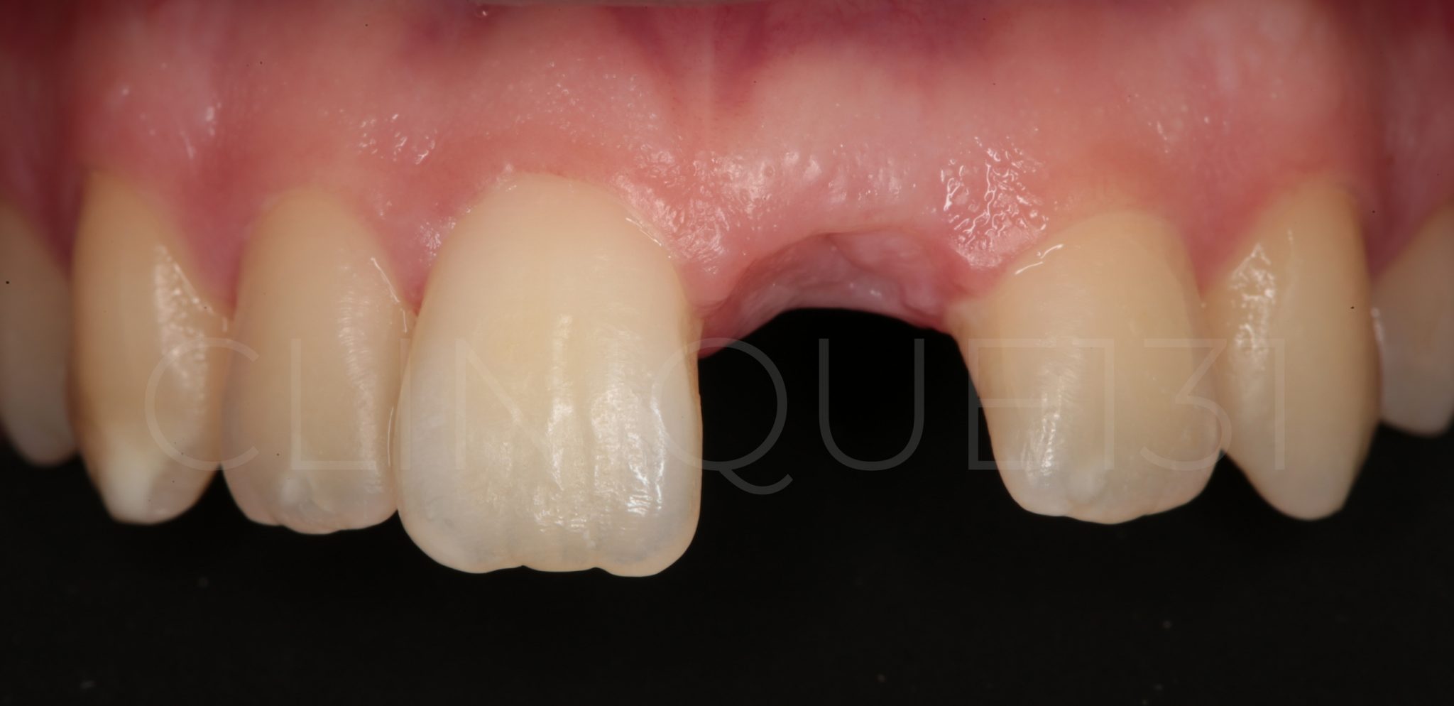 Je souhaite remplacer mes dents de devant Clinique 131