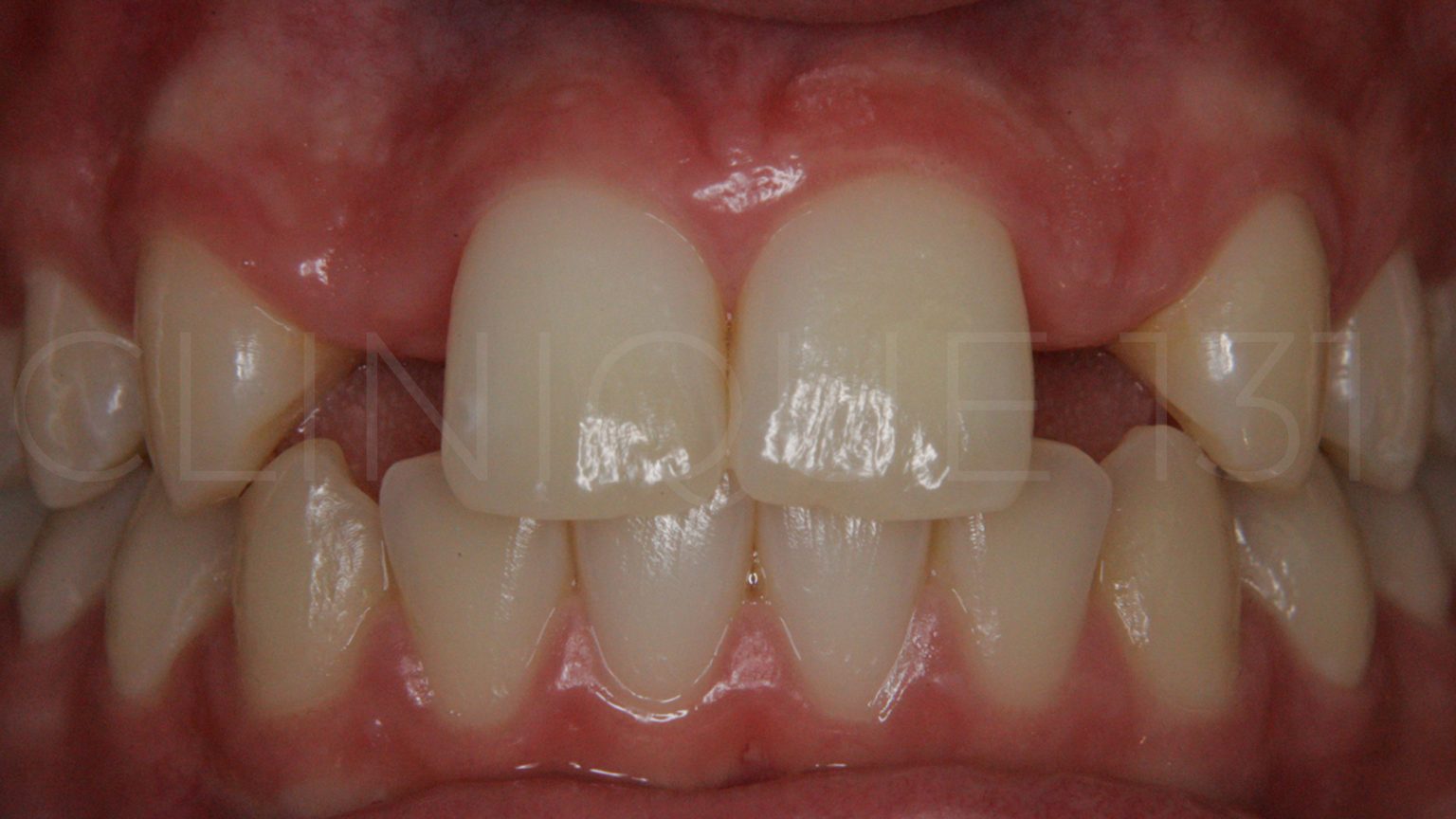 Je souhaite remplacer mes dents de devant Clinique 131