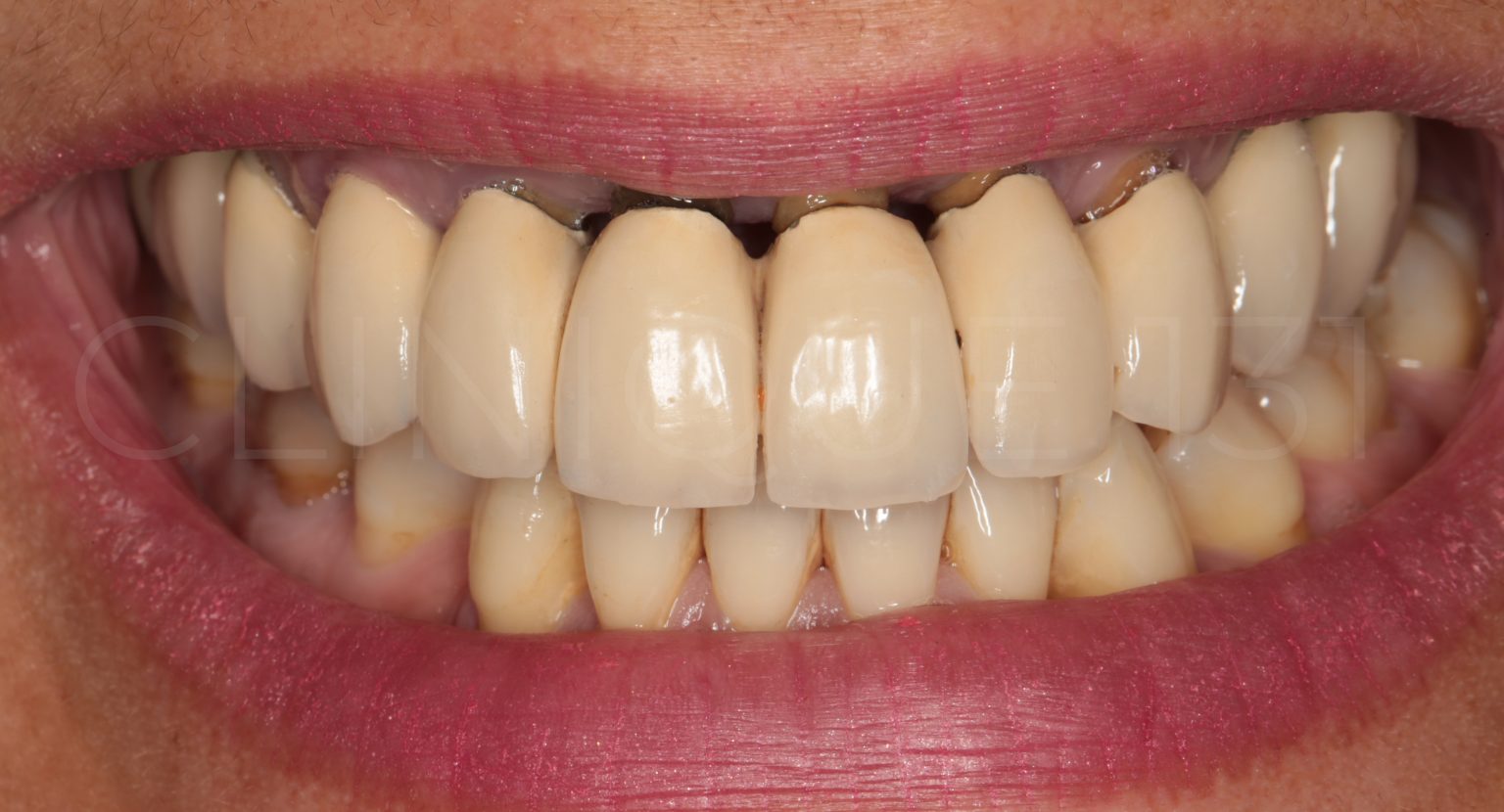 Je souhaite retrouver toutes mes dents dans la journée Clinique 131